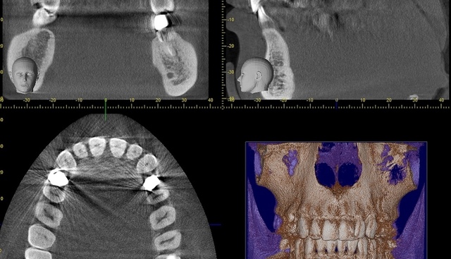 Sinuzită cronică, sau doar răceală? Cum te ajută CT-ul de sinusuri ...